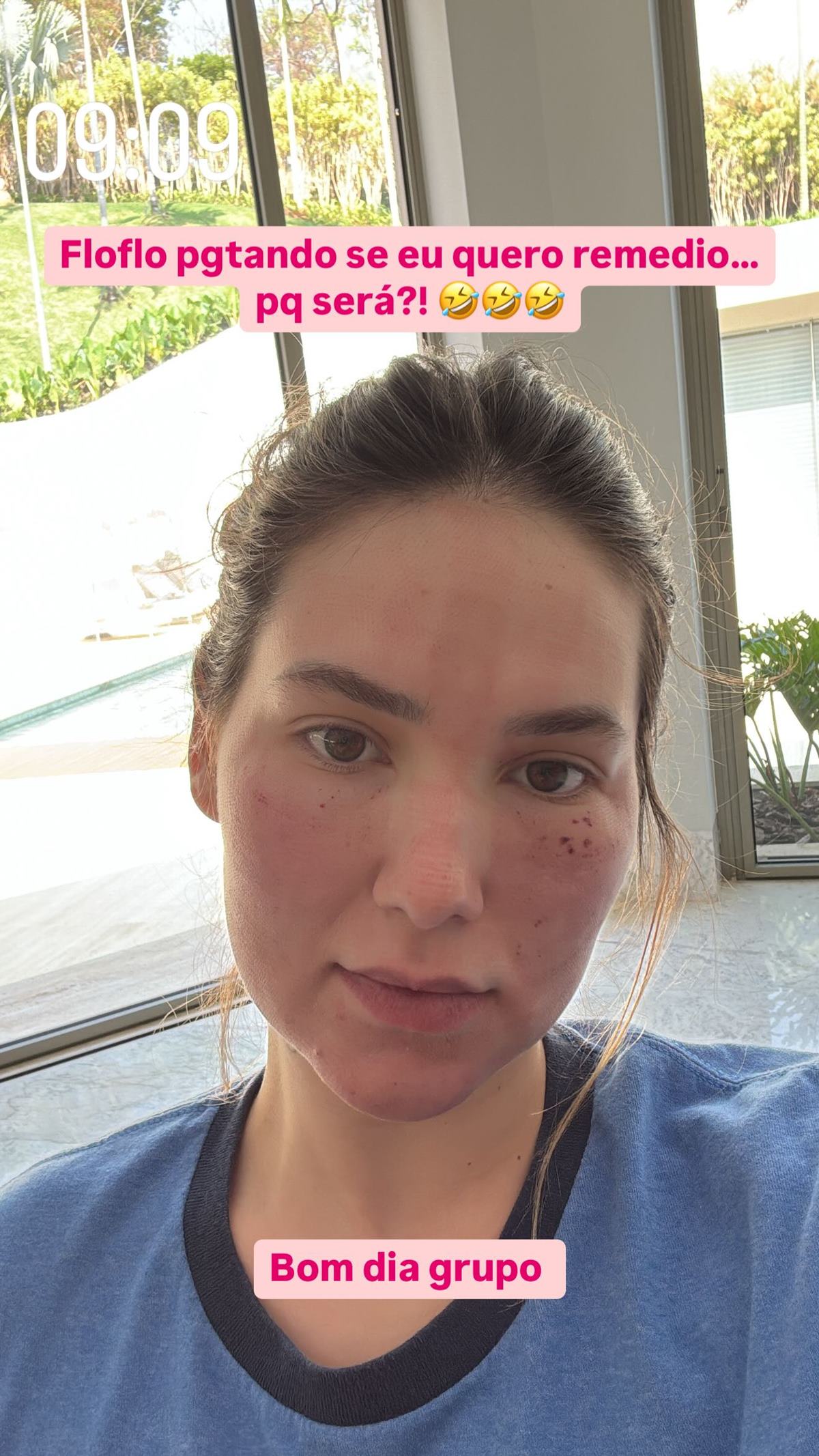 Virginia aparece com rosto deformado após procedimento; veja foto – TV ...